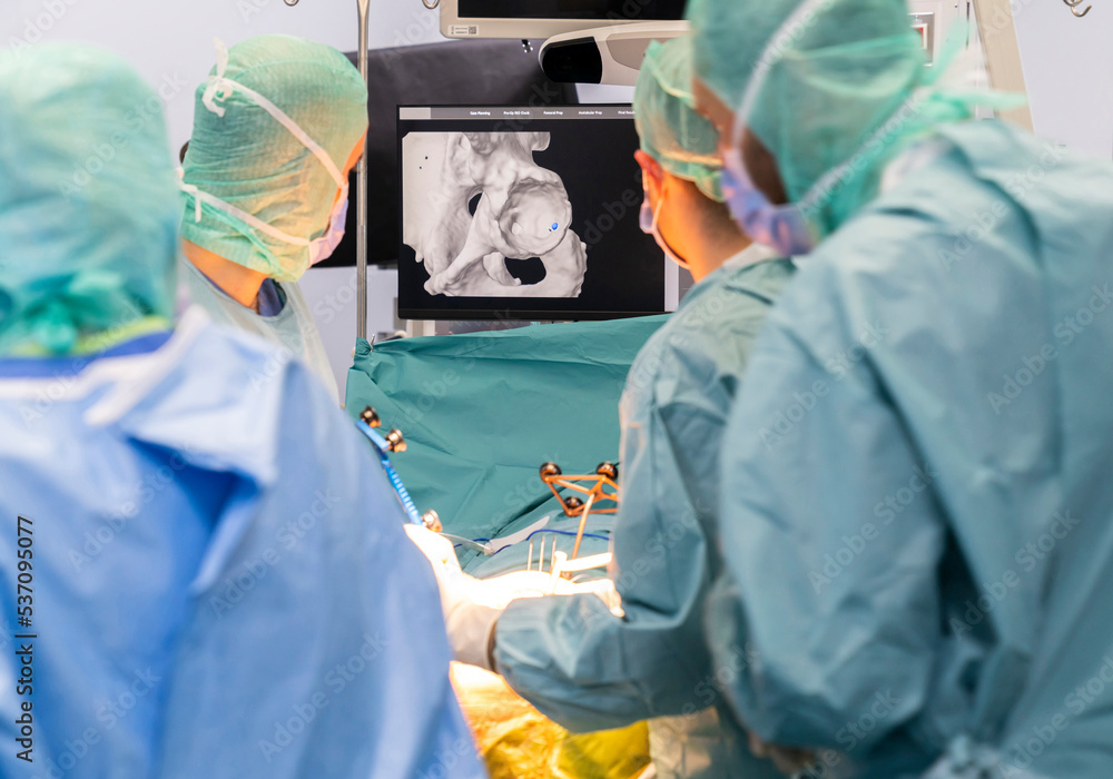 Team of doctor perform total hip arthroplasty replacement surgery in ...