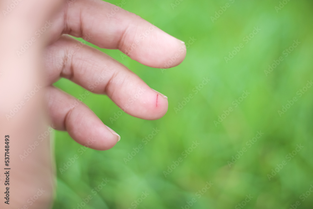 Wound from knife chop on ring finger while cooking blurred green ...
