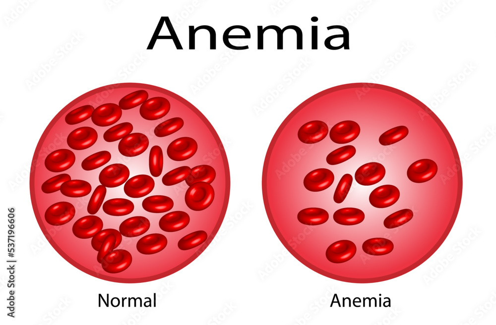 Iron deficiency anemia. The difference of Anemia amount of red blood ...