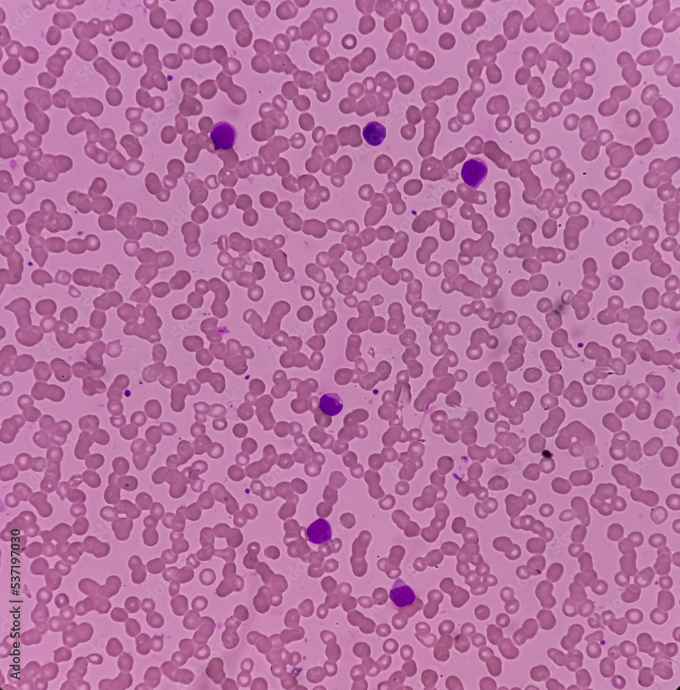 Foto de Acute myeloid leukemia (AML). AML is the most common leukemia ...