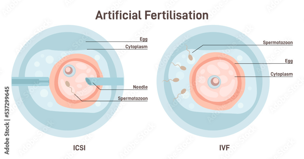 Artificial fertilization types. Female egg insemination by sperm with ...
