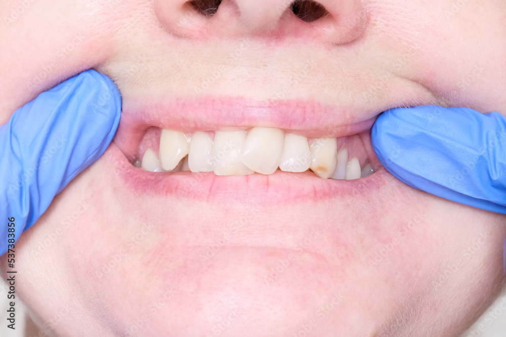 Adult woman teeth with malocclusion close up, orthodontic problem and ...