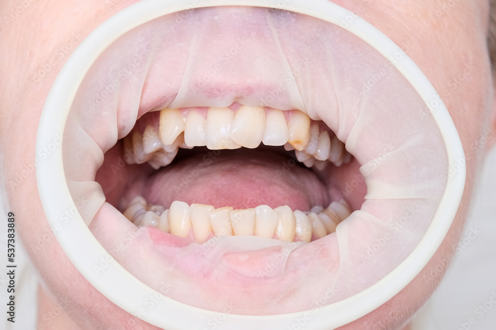 Adult woman teeth with malocclusion close up, orthodontic problem and ...