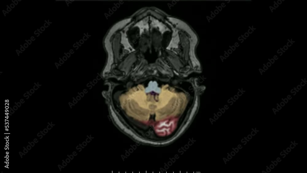 CT Brain scan image MRI human anatomy disease research healthy adult ...