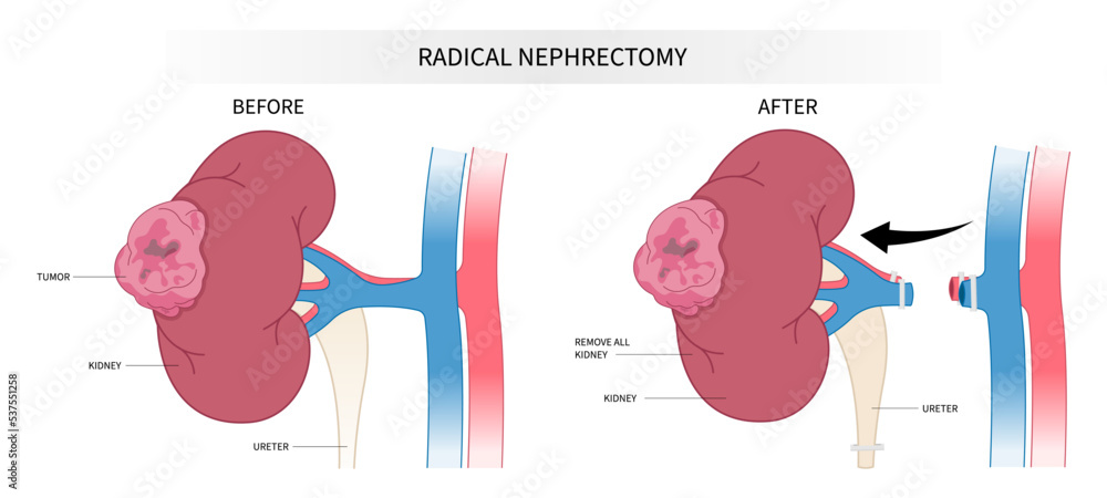 kidney donation with Laparoscope minimally invasive surgery of ...