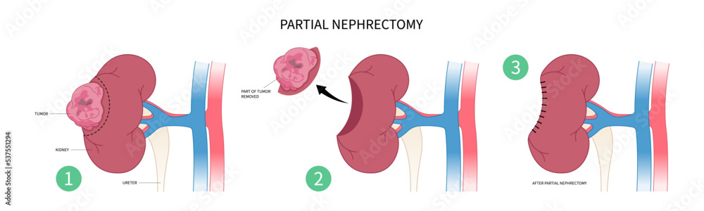 Poster Laparoscope Nephrectomy surgery for kidney donation with ...