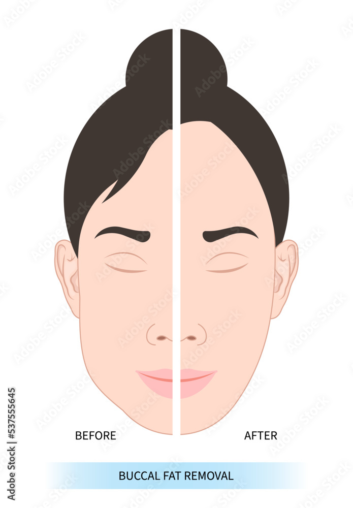 Before and after Cheek buccal fat removal with augment excess slim face ...