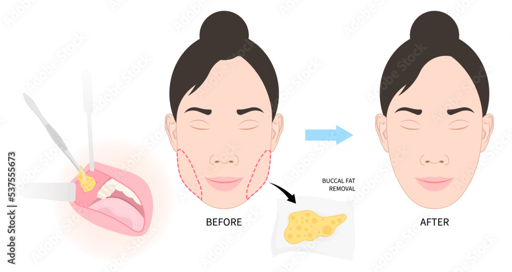 Cheek buccal fat removal and augment excess slim face of Bichat’s ...