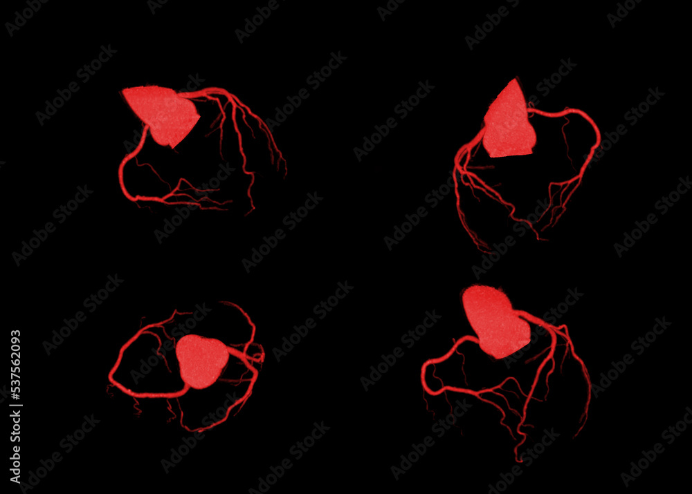 Collection of CT Cardiac 3D or CTA coronary artery for Check up ...