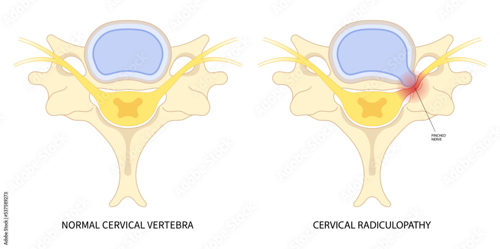 Vecteur Stock traumatic Spinal cord injury with painful pinched nerves ...