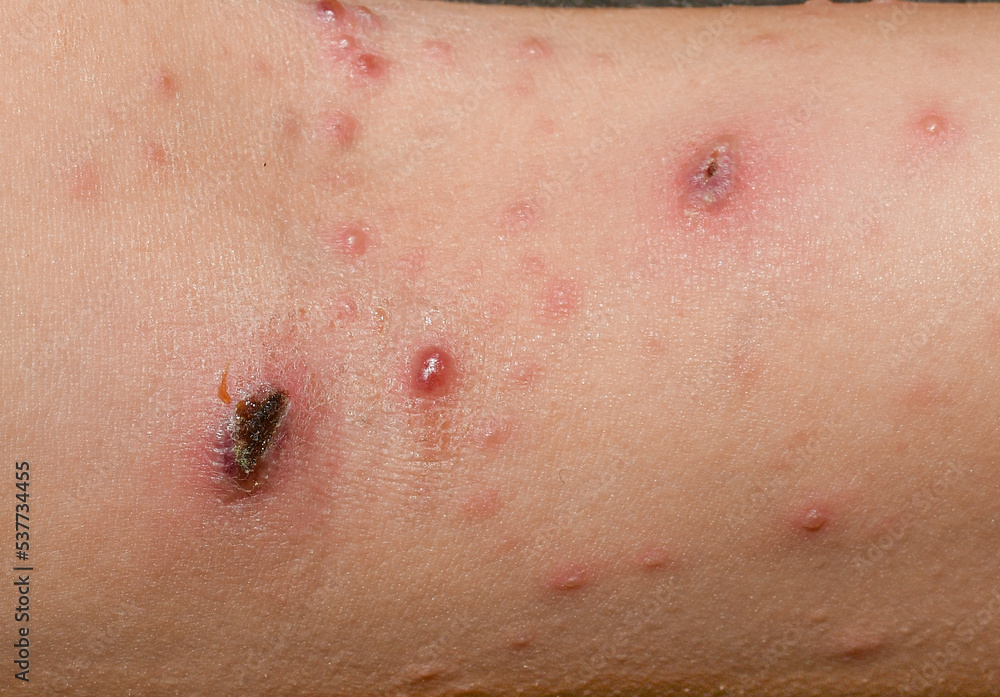 Chickenpox on the body of a child, Severe chicken pox crusts on rashes ...