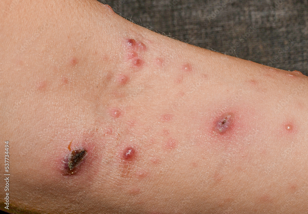 Chickenpox on the body of a child, Severe chicken pox crusts on rashes ...