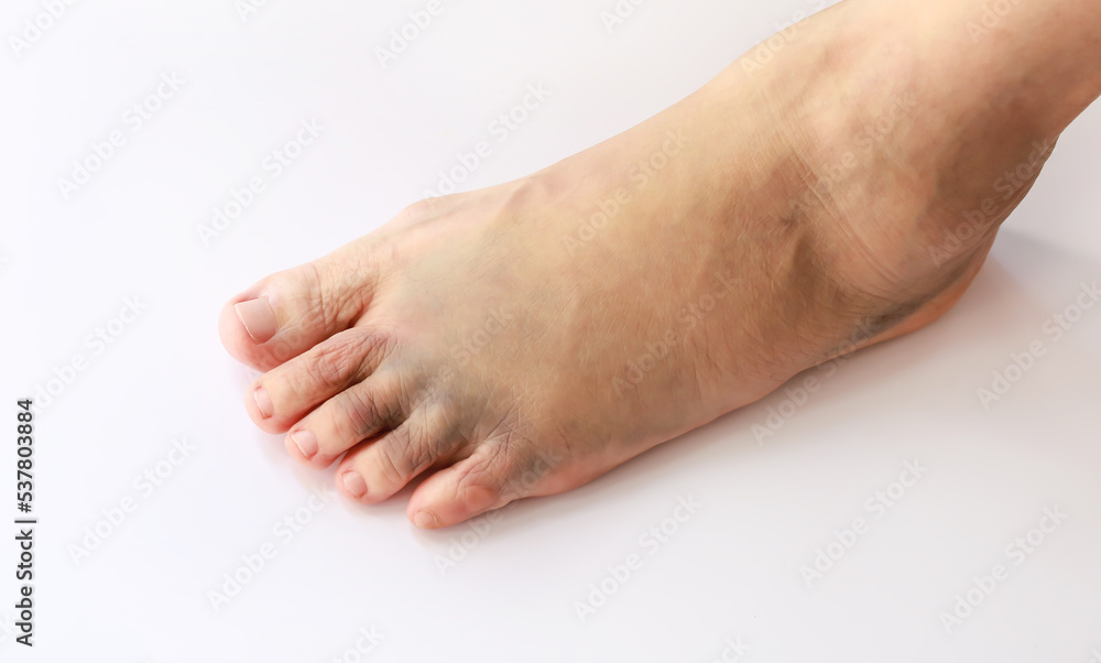 Left foot bruise or contusion and swollen cause by injury Stock Photo ...
