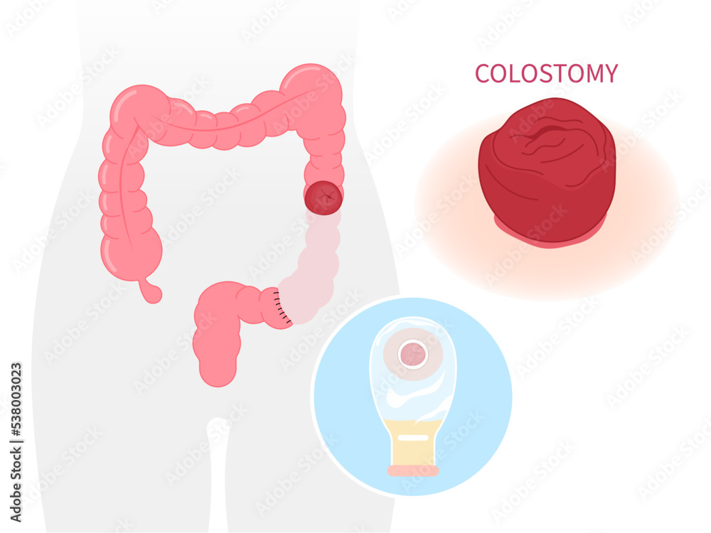 Small and Large Colon blocked Surgery abdomen Pouch with Crohn ...