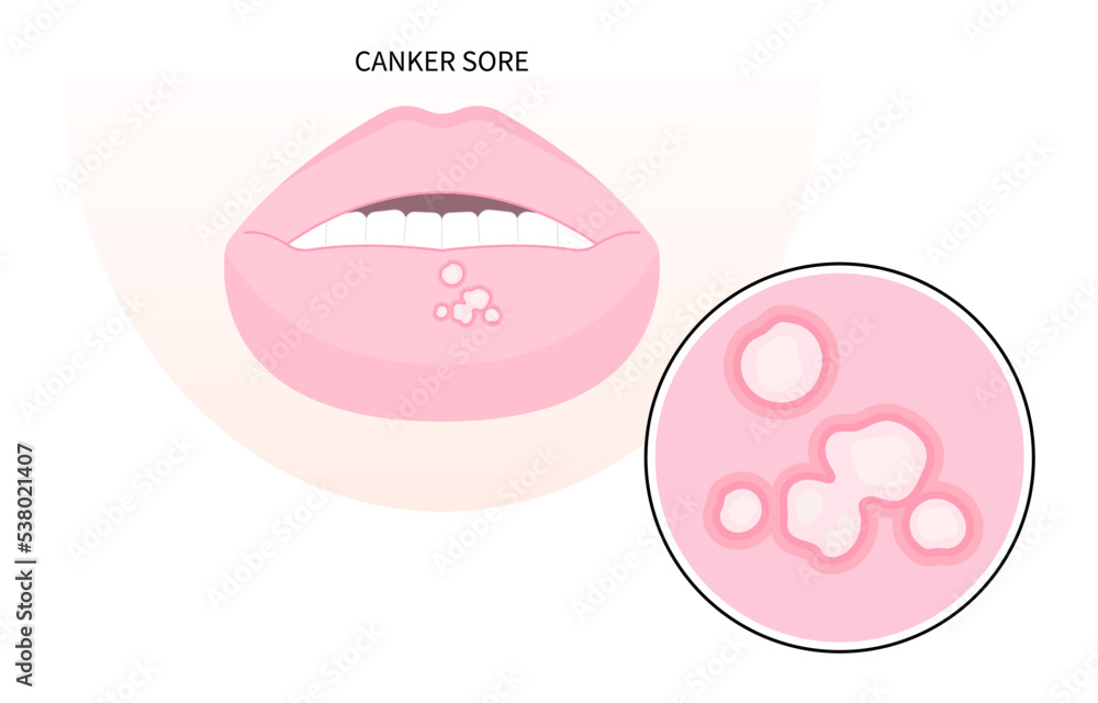 Human Papilloma of HIV and AIDS bacterial fungal Viral canker sore lip ...