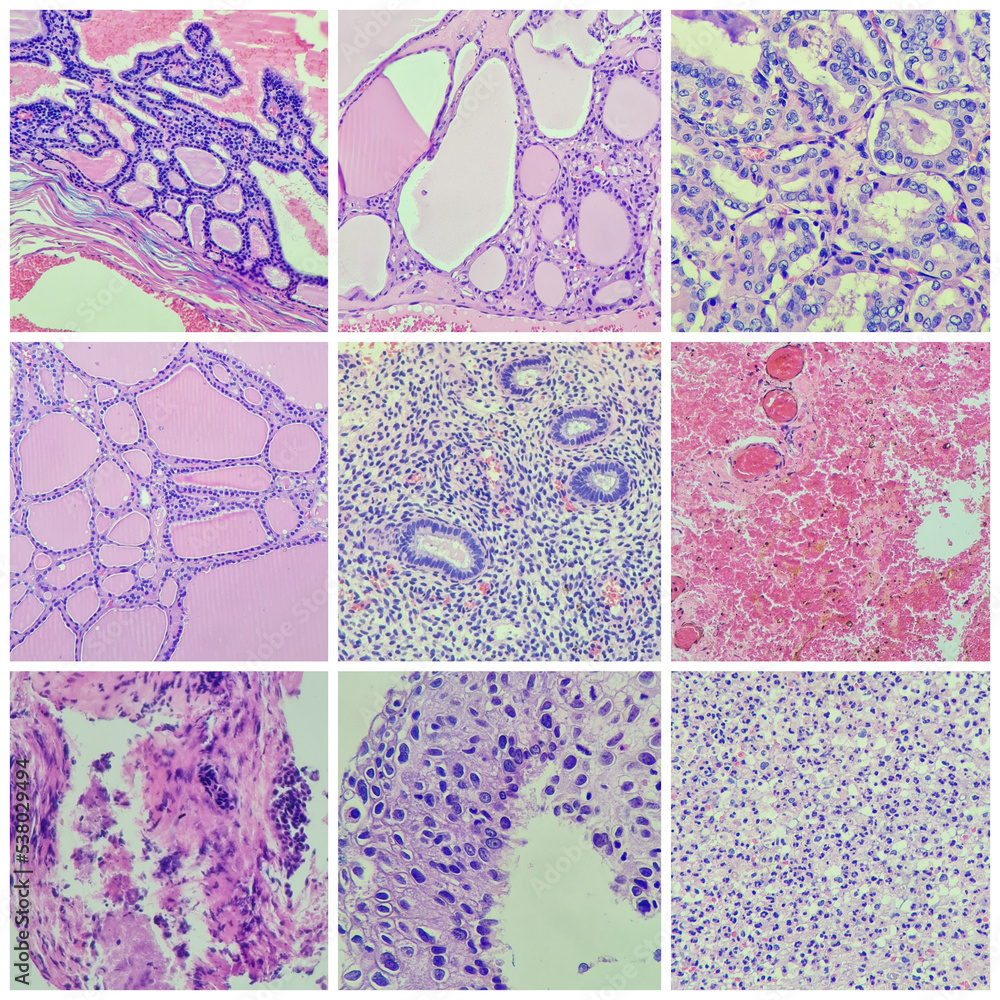 Foto de Camera photo of various pathological slides from thyroid gland ...