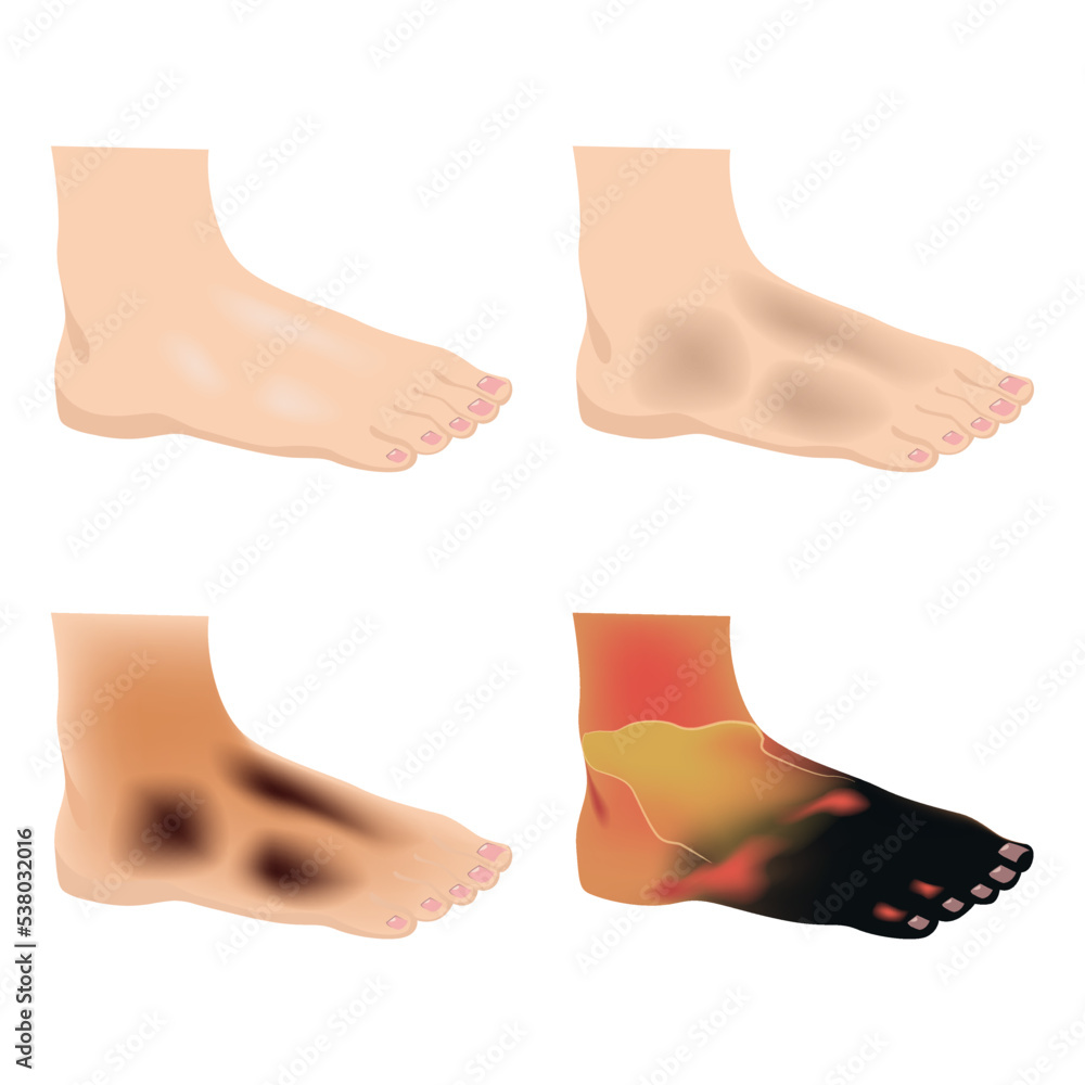 Stages of limb ischemia. Gangrene of the legs. Medical poster vector ...