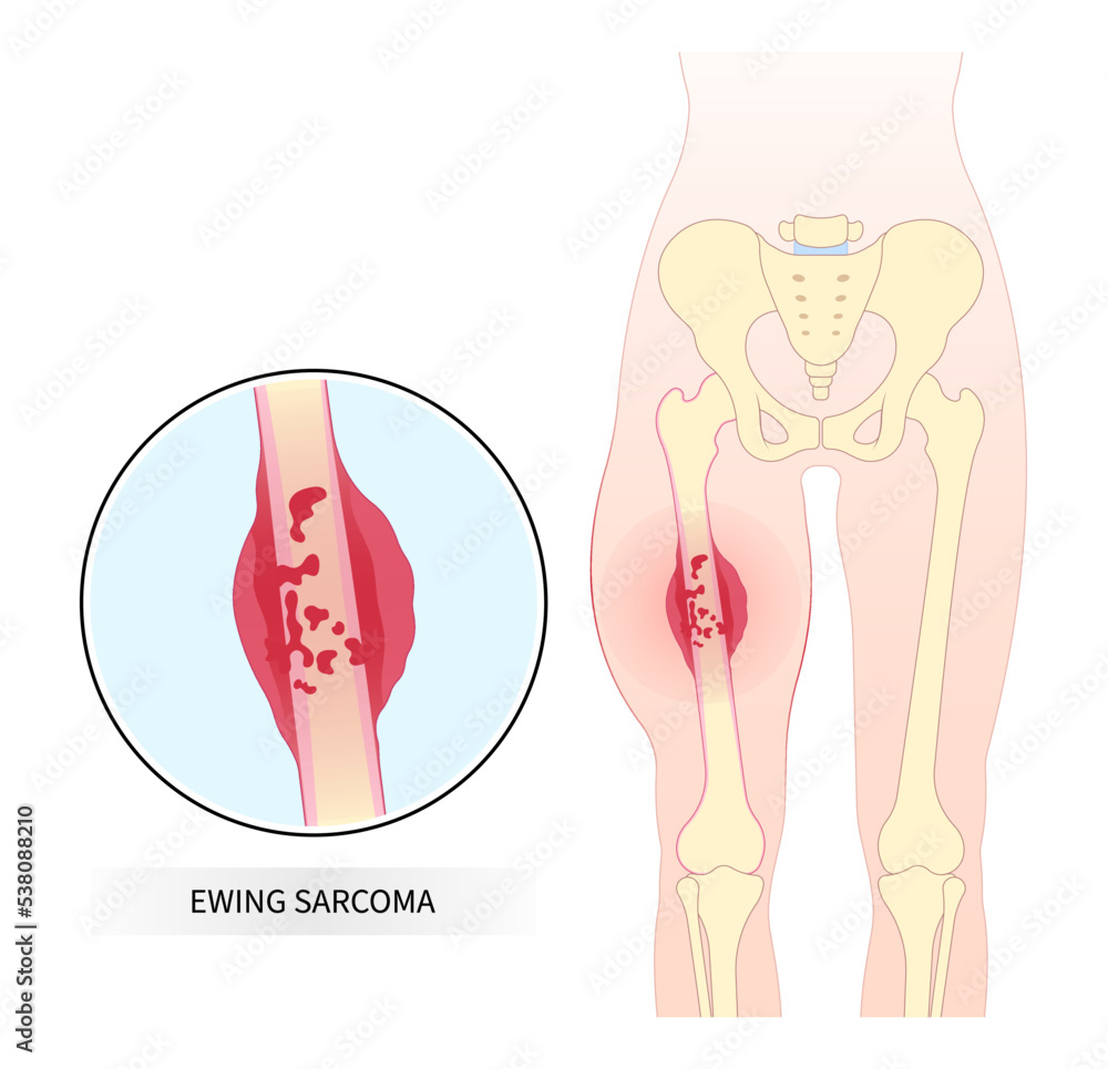 inflammation leg bone with tumor cell the Ewing's sarcoma hip femur gross pain and soft tissues ...