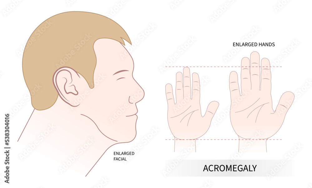acromegaly giant enlargement body with Insulin like Factor hormonal ...