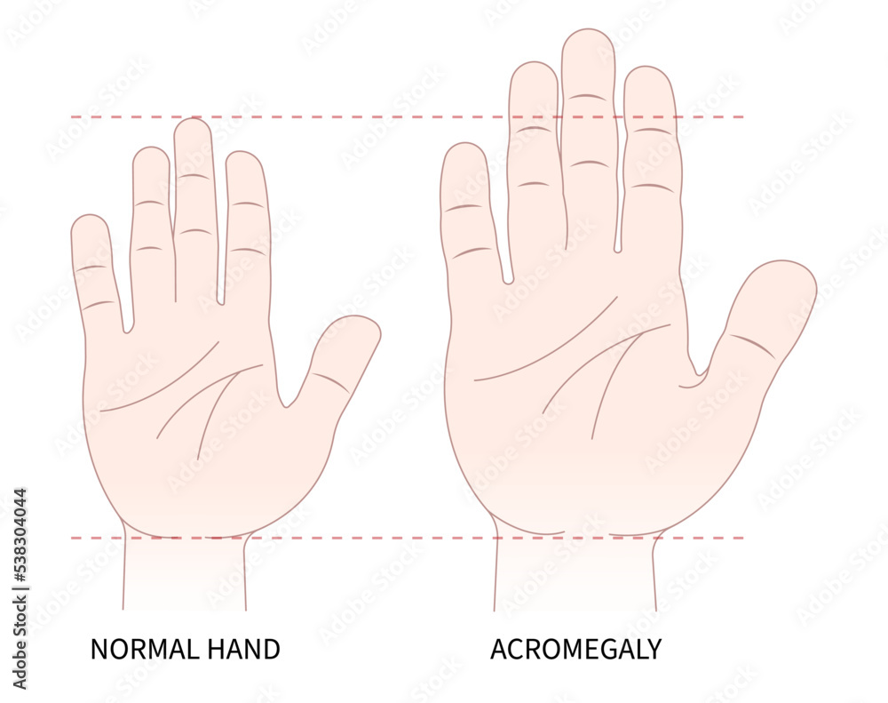 enlargement body of acromegaly giant with Insulin like Factor hormonal ...