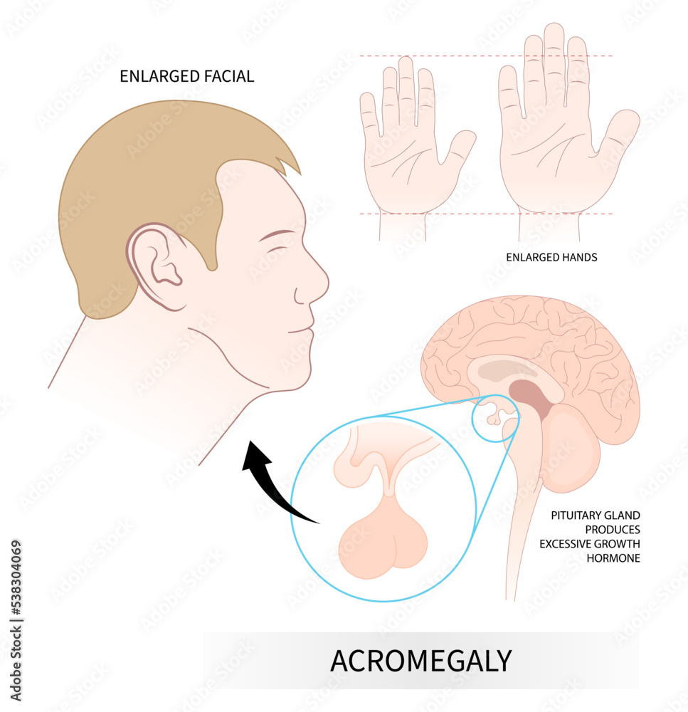enlargement body of acromegaly giant with Insulin like Factor hormonal ...