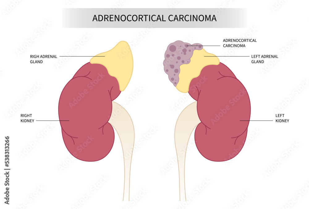 Kidney carcinoma gene mutation Adrenal Disorder with Addison’s or ...