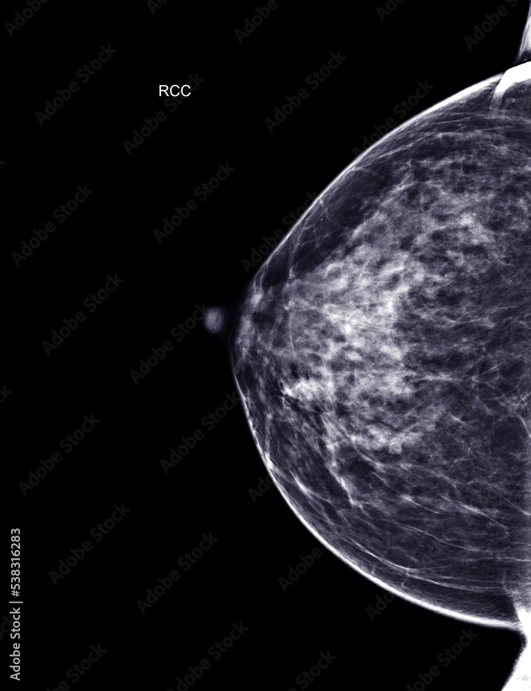 X Ray Digital Mammogram Or Mammography Of Both Side Breast Standard