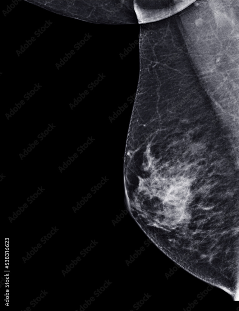 X-ray Digital Mammogram or mammography of both side breast Standard ...