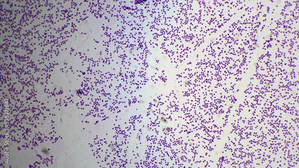 Smear of human blood under microscope with 100 times magnification on ...