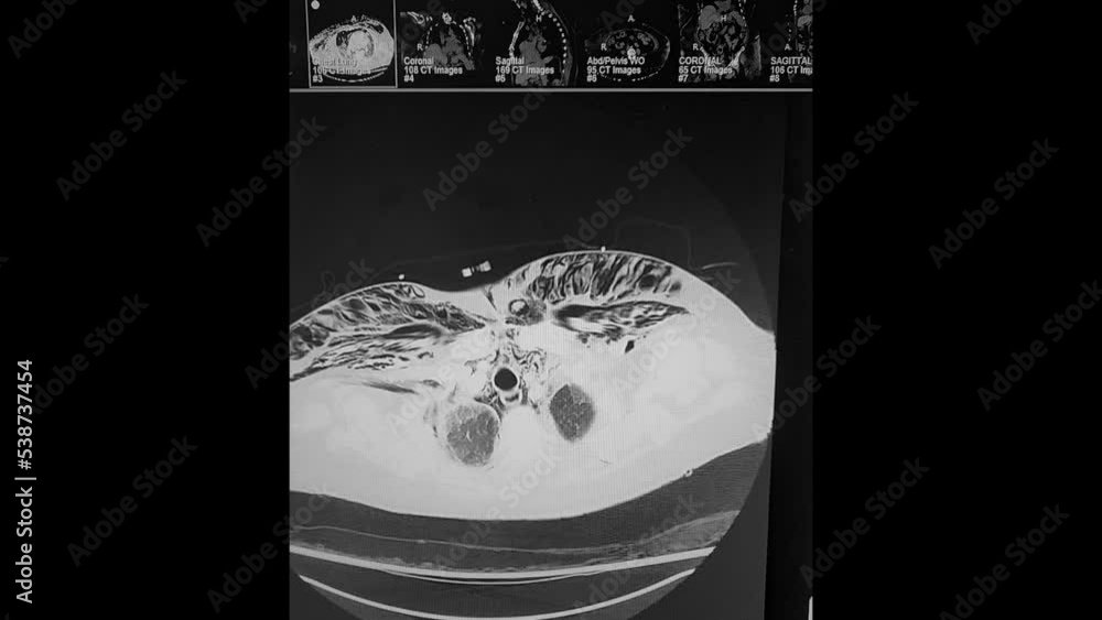 CT Chest - pneumomediastinum and subcutaneous emphysema w interstitial ...
