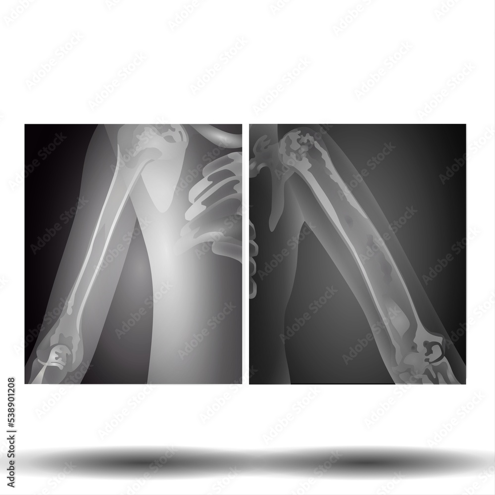 X-Ray of Hand - Upper Limb - Fla source file available - The upper limb ...