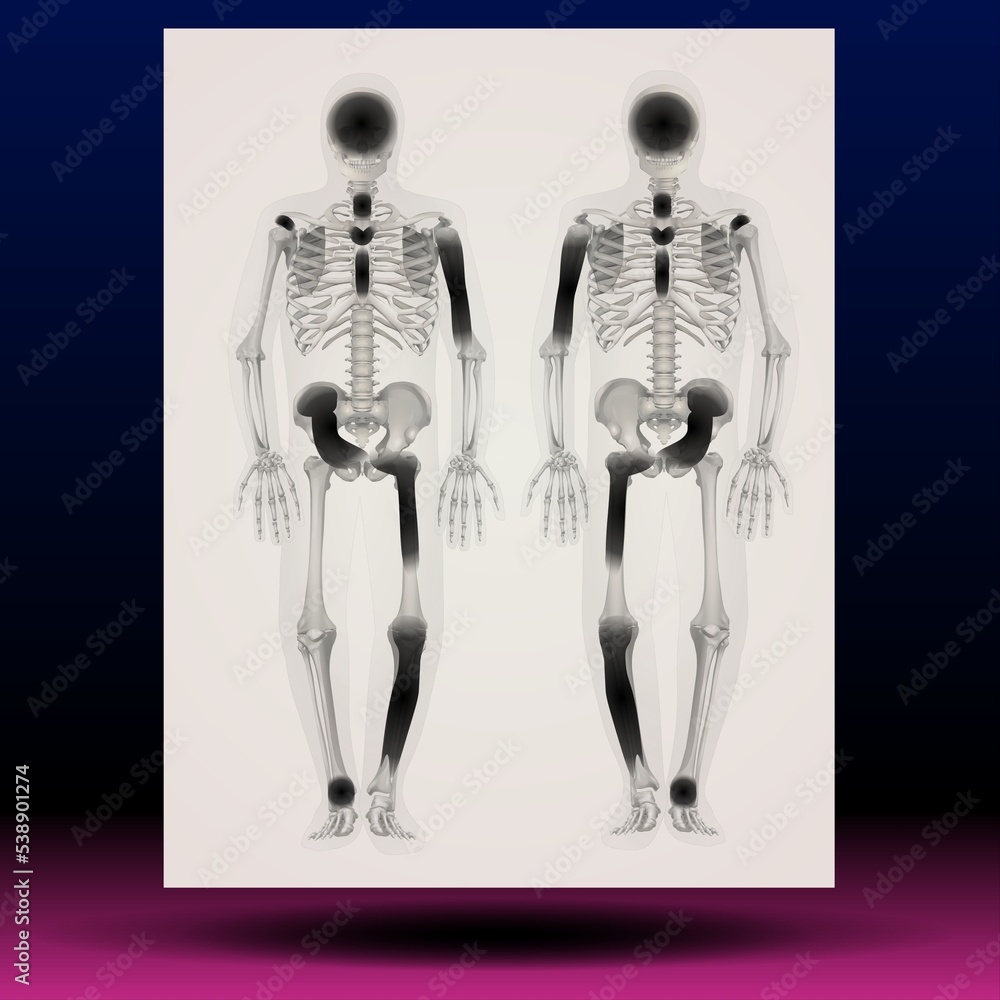 X-Ray of Hand - Upper Limb - Fla source file available - The upper limb ...