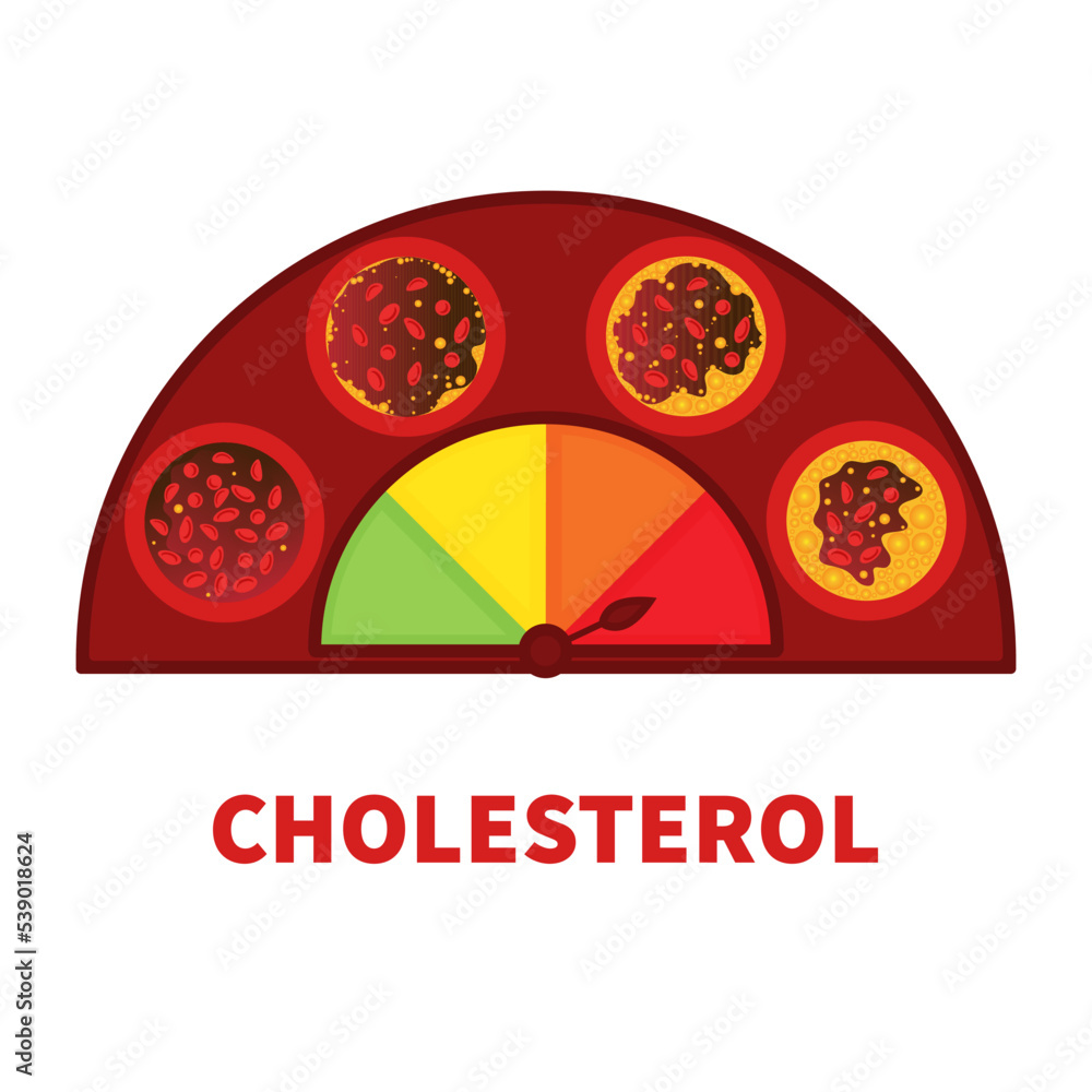Cholesterol level on blocked blood vessel medical diagram ...