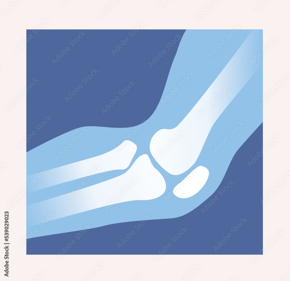 Xray scan concept. Anatomical poster with knee joint, fibula, tibia and ...