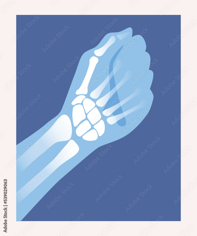 Xray scan. Anatomical poster with bones and joints of hand, palm and ...