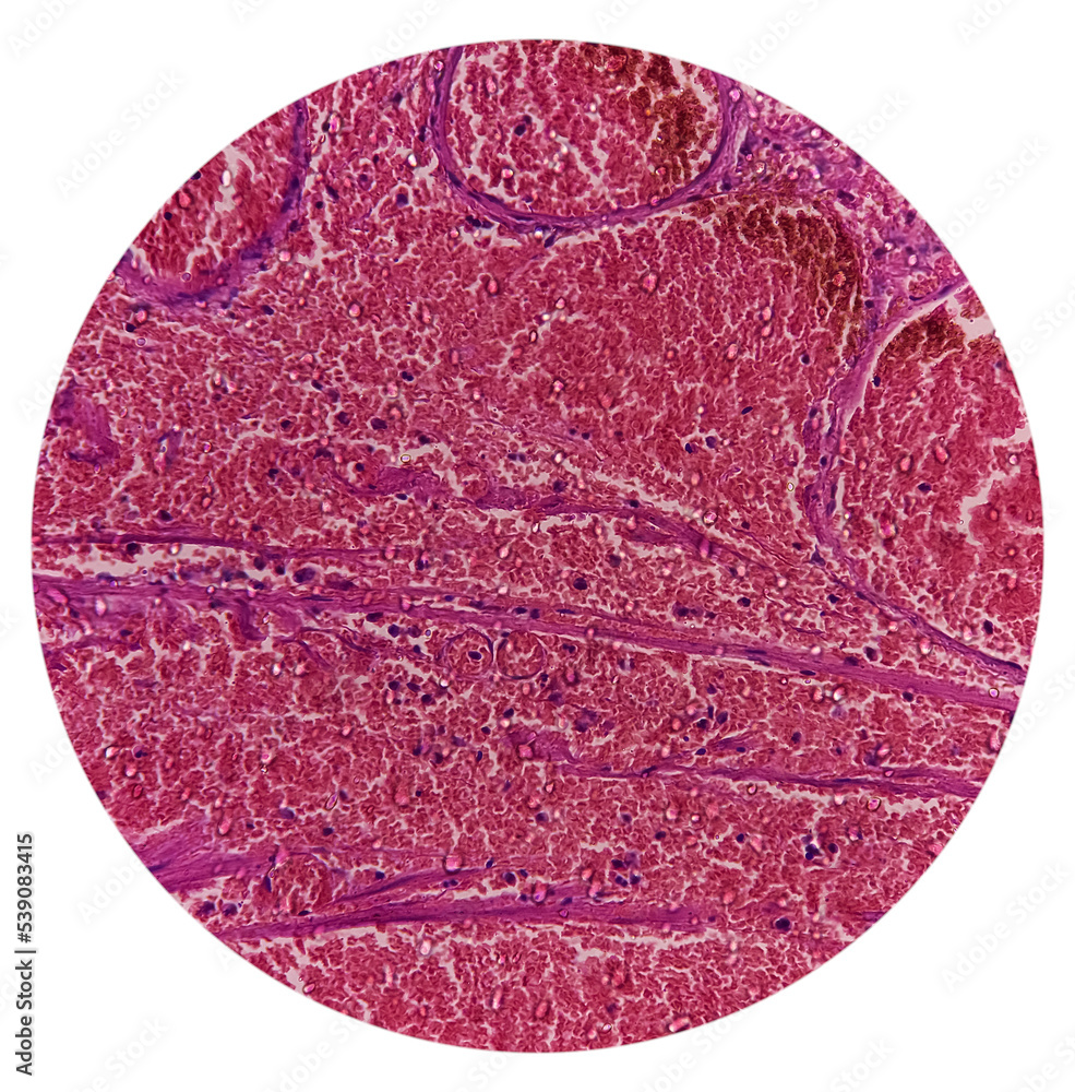 Ovarian cyst: Haemorrhagic cyst. Microscopic show ovarian cyst wall of ...