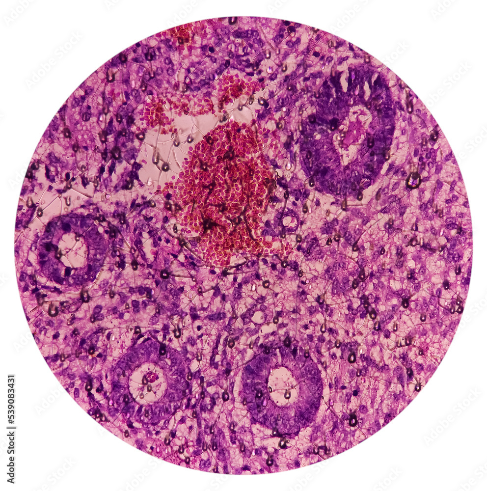 Endometrial tissue: Photomicrograph of endometrial tissue ...