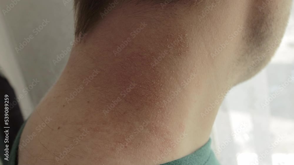 dry and reddened skin in a man on the neck, dermatology. Skin disease ...