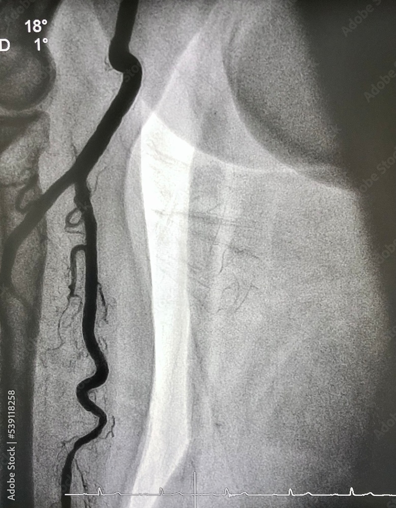 Angiogram shown tortuous right radial artery. Stock Photo | Adobe Stock