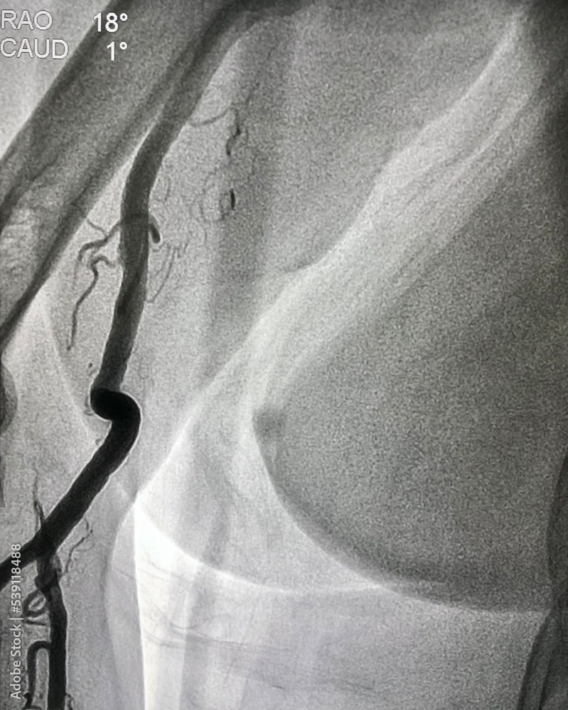 Angiogram shown tortuous right radial artery. Stock Photo | Adobe Stock