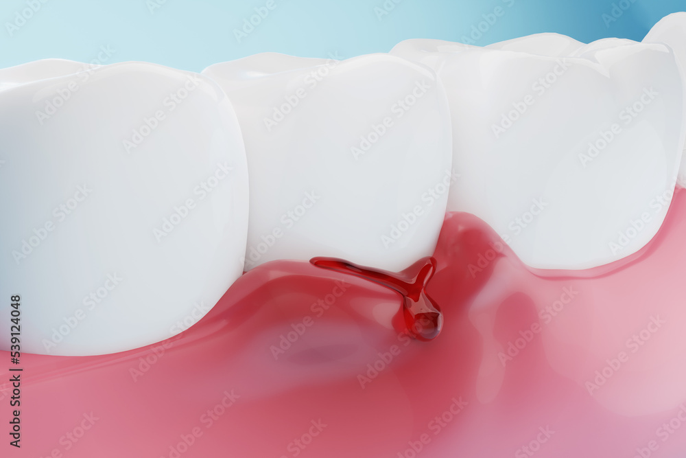 Bleeding gums. dental hygiene and healthy teeth concept. 3D rendering ...