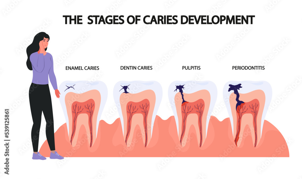 Caries development stages. Dentistry concept. Infographics. Tooth decay ...
