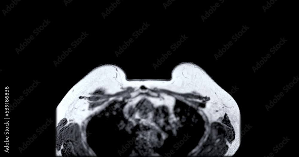 Breast MRI magnetic resonance imaging of the breast uses radio waves ...