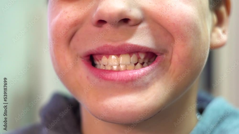 The boy shows his teeth. Extra fangs grow. Shark teeth. At the dentist ...