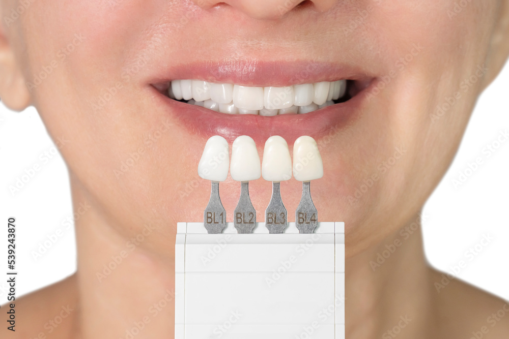 Tooth whitening, perfect white teeth close up with shade guide bleach ...