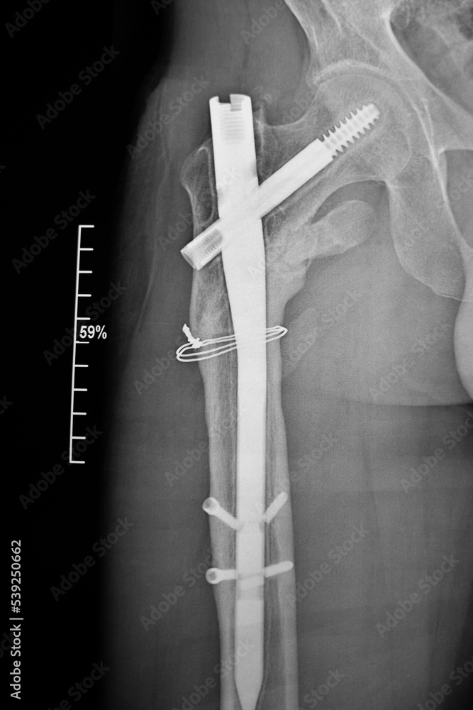 X-ray of the leg with a titanium pin. hip fracture. medical snapshot ...