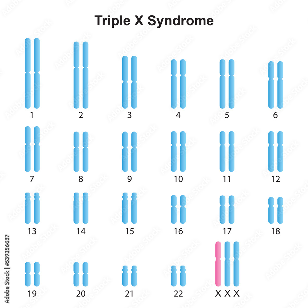 Vecteur Stock Scientific Designing Of Triple X Syndrome Trisomy X vecteur-stock-scientific-designing-of-triple-x-syndrome-trisomy-x