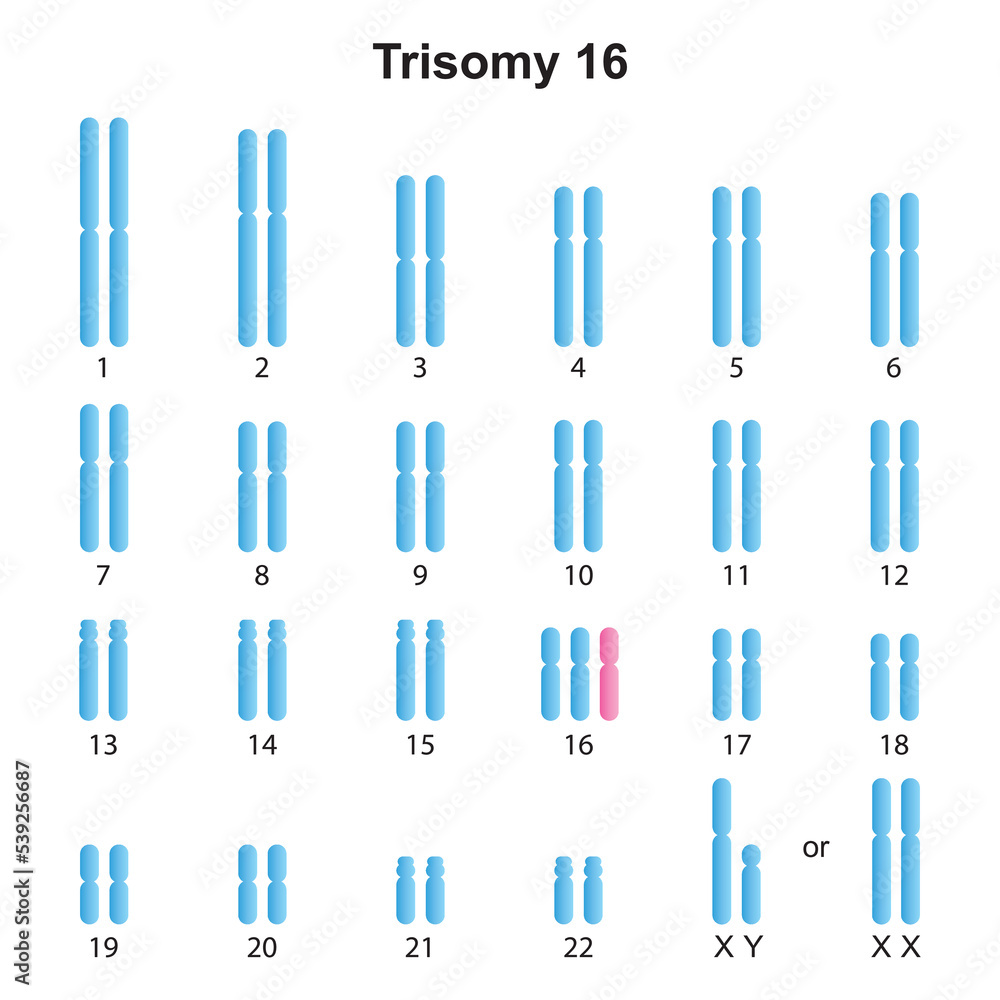 Scientific Designing of Mosaic Trisomy 18 Karyotype. Colorful Symbols ...