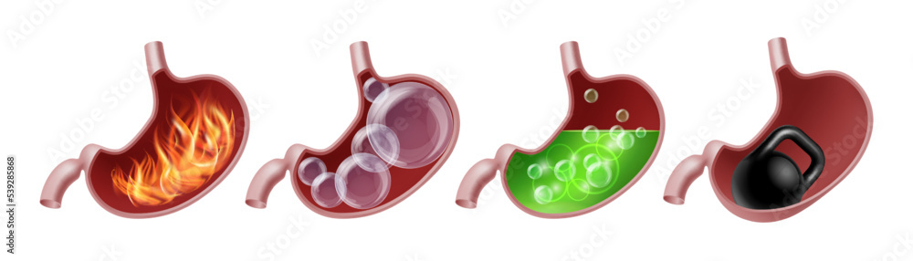 Photo Diseases of stomach. Medical vector illustration set., tassel78 ...