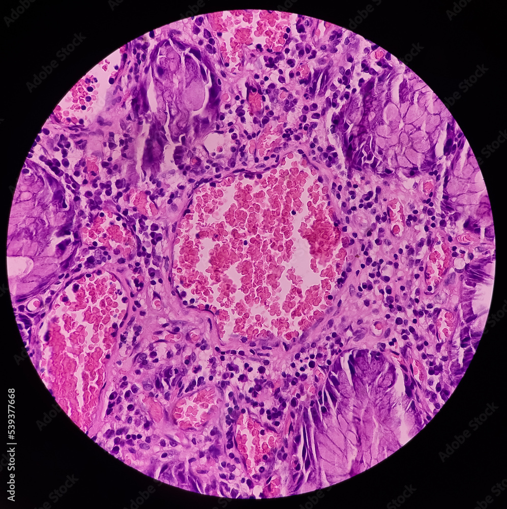 Gastric polyp biopsy: Adenomatous polyps. Showing gastic mucosa, a ...